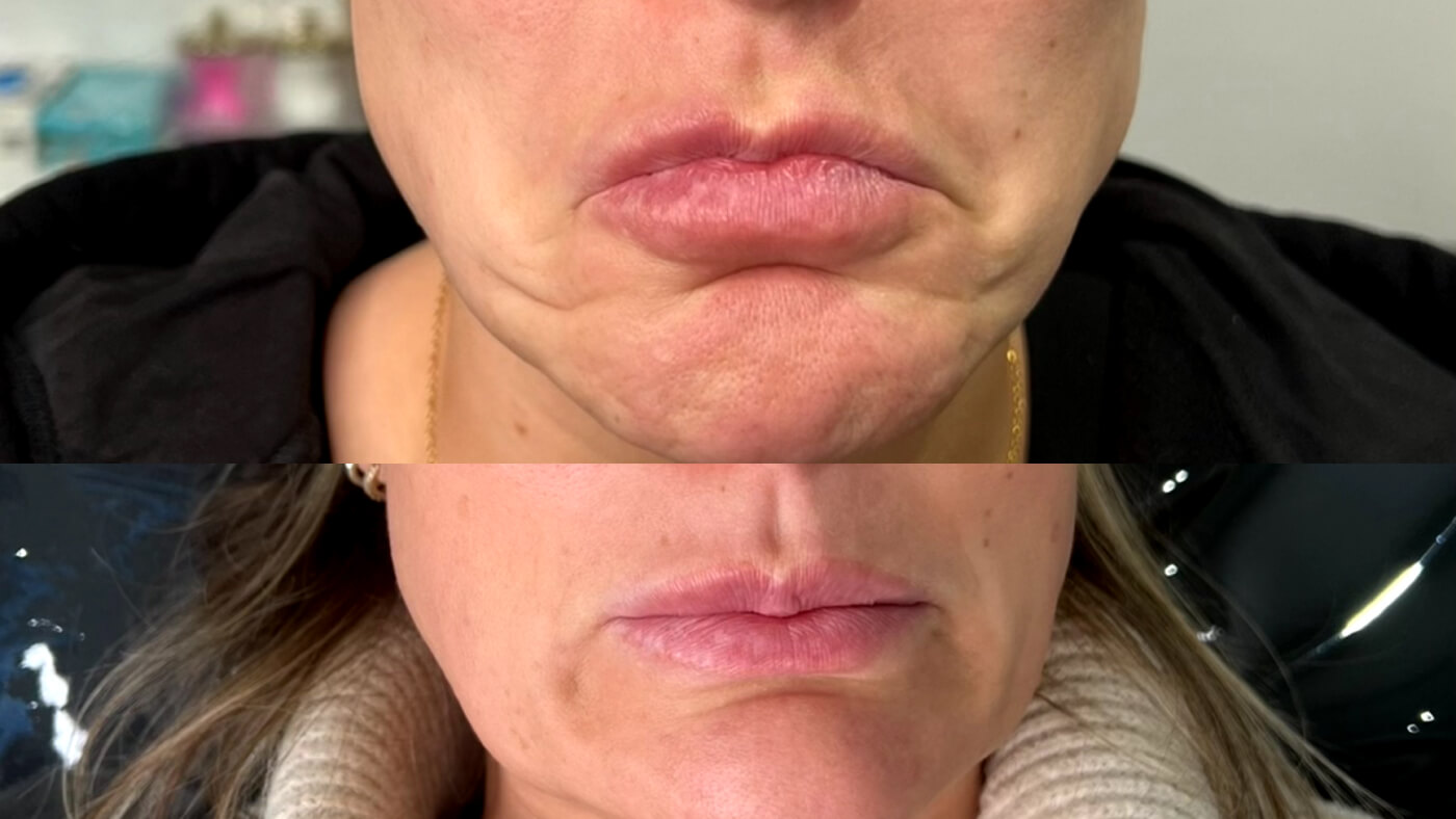 DAO Botox (Sad Mouth) – Pink Panther Aesthetics | Peptide | Training